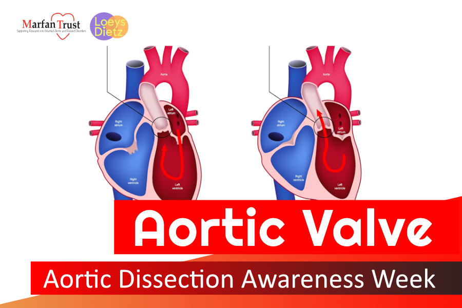 aortic mdt